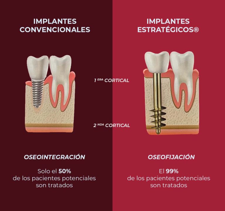 Implantología Estratégica: Recupera Tu Sonrisa en 72 Horas con ...